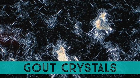 Gout Crystals Fixed In Ethanol Monosodium Urate Uric Acid Gouty Tophus