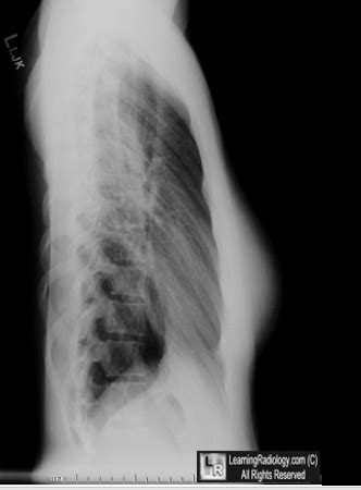 Thoracic X Ray Osce Flashcards Quizlet