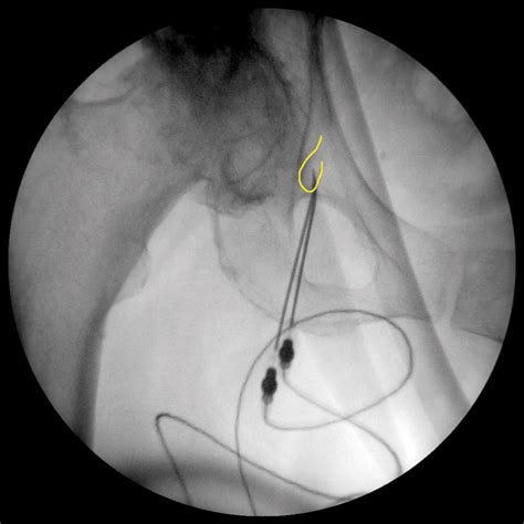 Complications Of Obturator Nerve Block Anesthesia Key