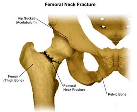 Non Displaced Subcapital Femoral Neck Fracture Prognosis