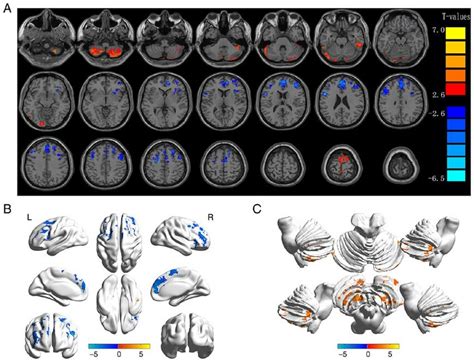 Spontaneous Brain Activity In Diabetic Patients With Vh Vs Ncs A Download Scientific
