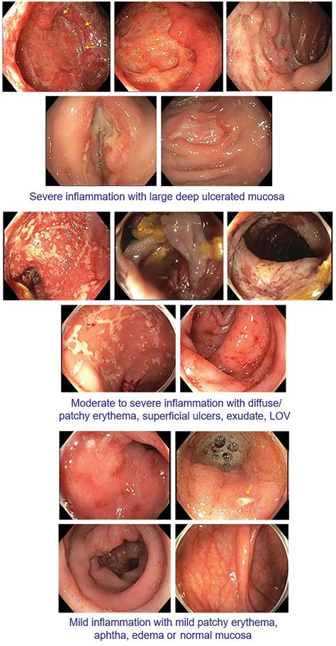Ulcerative Colitis Endoscopy Ulcerative Colitis Knowledge Amboss
