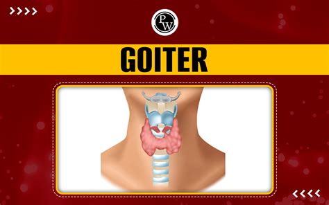 Goiter Introduction Types Symptoms Root Causes