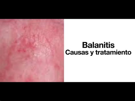 Balanitis Qué Es Y Cómo Tratarla