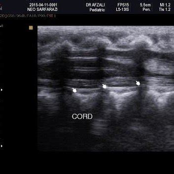 A Sacral Pit B Skin Tag And C Tuft Of Hair Download Scientific