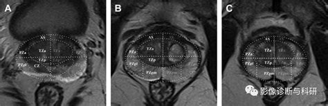 前列腺解剖分区及mr表现