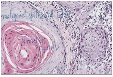 Grading And Staging Flashcards Quizlet