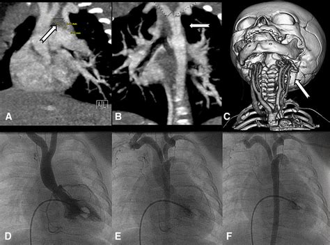 Two Dimensional Scan Frontal Reconstructed Images Showing The Aortic