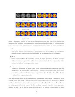 Brain MRI Segmentation With Fast And Globally Convex Multiphase Active