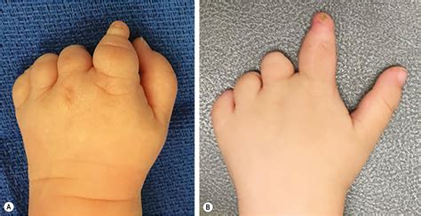 Congenital Hand Iii Malformations Abnormal Axis Differentiation Hand Plate Proximodistal