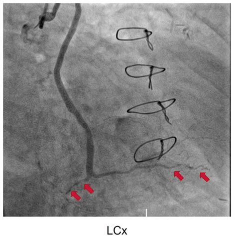 10 Cxa Of The Left Circumflex Artery For Patient 1 Examples Of Download Scientific Diagram