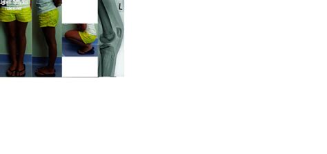 Guided Growth For Tibial Recurvatum Pmc