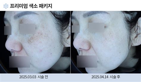 마곡피부과진료 스노우의원 마곡점 마곡보톡스 마곡여드름