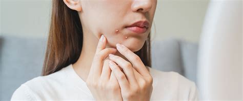 How To Pop A Pimple Azclear Australia