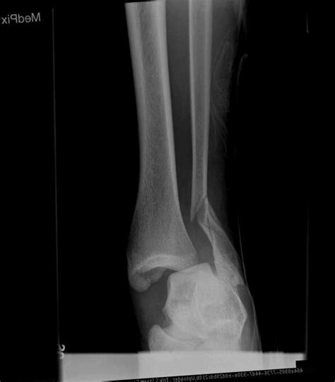 Science Research 2022 Bone Fracture Detection Object Detection Dataset V8 2022 12 19 1 00pm