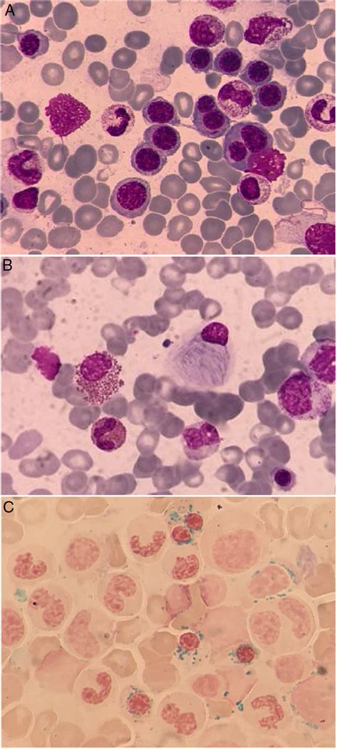A Bone Marrow Aspirate Showing Several Erythroblasts Displaying Download Scientific Diagram