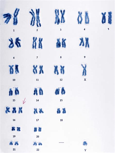 Abnormal Karyotype Trisomy 16