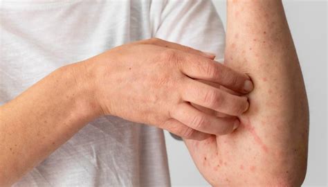 التهاب الجلد التأتبي احذر الصوف ودخان التبغ