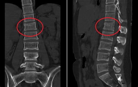자전거사고로 인한 척추압박골절 보상 알아보기 네이버 블로그