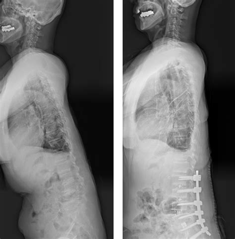 “80세 이상 고령자 척추 수술 통증 감소시키고 안전” 당신의 건강가이드 헬스조선