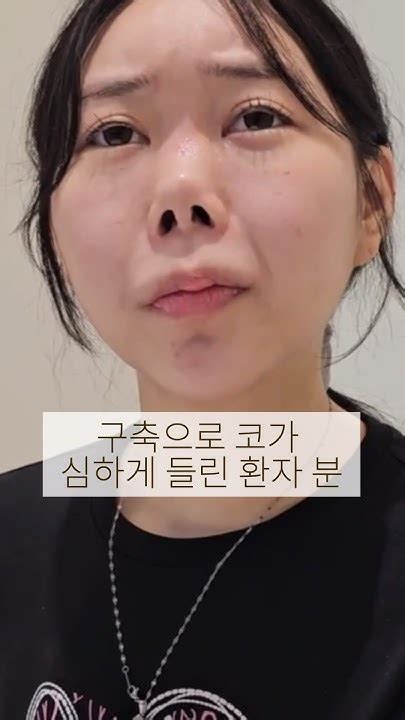코 구축으로 휴학까지 했어요 코재수술 코성형부작용 Shorts Youtube