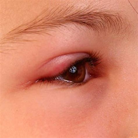Swollen Eyelid Due To Makeup Allergy Saubhaya Makeup