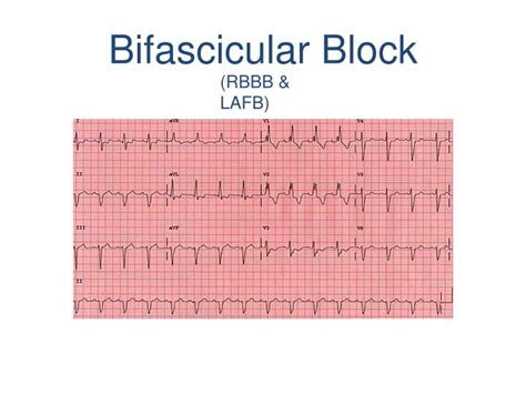 Ppt Bundle Branch Blocks Powerpoint Presentation Id 4807495