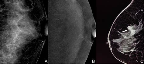 Breast Suspicious Microcalcifications On Contrast Enhanced Mammograms