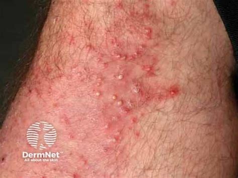 Folliculitis Genital Area Women Folliculitis Treatment How Do You