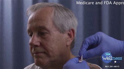 Neurostimulator Therapy YouTube