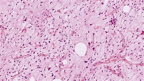 Dedifferentiated Liposarcoma Pathology