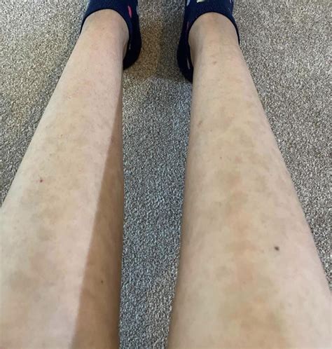 Leg Discolouredhyperpigmentation Rdermatologyquestions