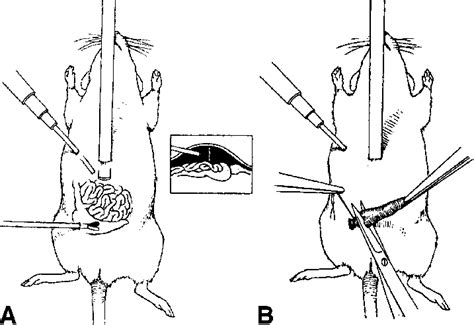 For Laparoscopic Assisted Cecectomy Three Ports Were Used A And