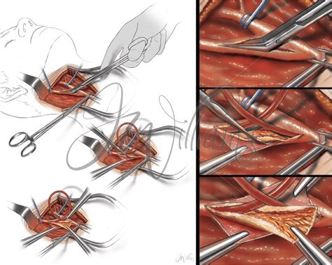 Endarterectomy On Behance