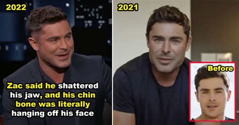 Zac Efron Talks Jaw Injury Plastic Surgery Rumors