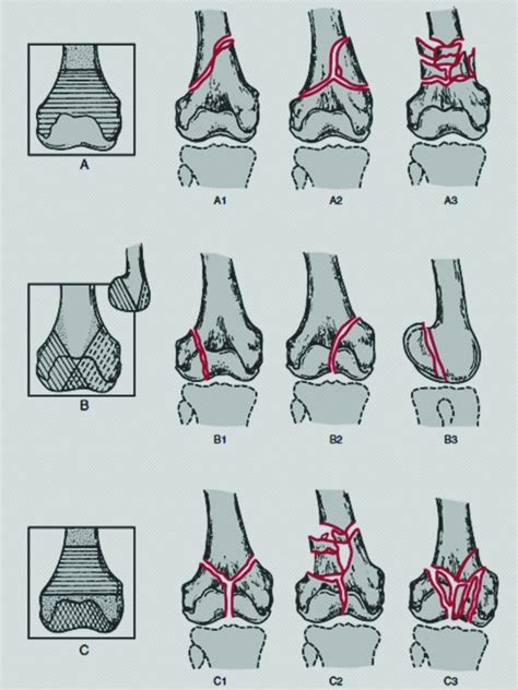 Classification Of Distal Femur Fractures And Their Clinical Relevance