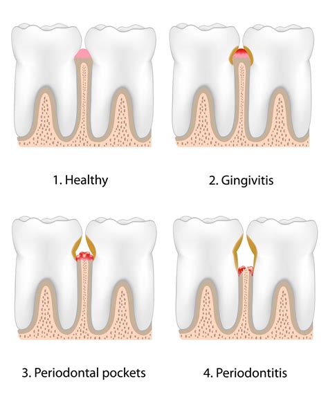 Periodontal Therapy Kansas City Mo Matthew A Turner Dds Pc
