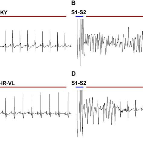 Schematic Representation Of Ventricular Arrhythmia After In Vivo