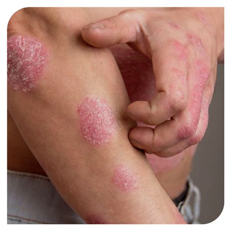 Psoriase Isadora Miotto