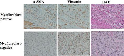 Myofibroblasts Are Associated With The Progression Of Scirrhous Gastric