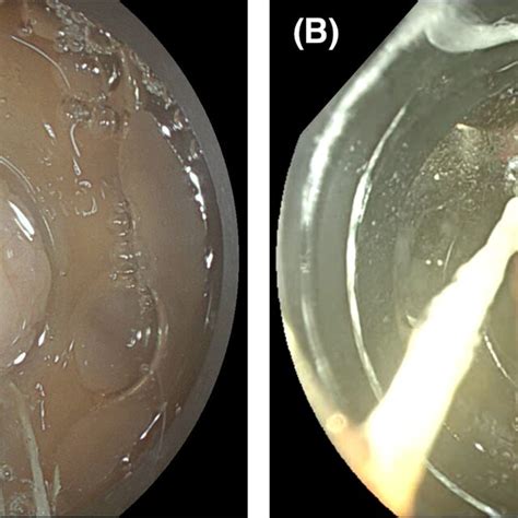 A Linked Color Imaging Lci Of A Representative Angioectasia Of A Download Scientific