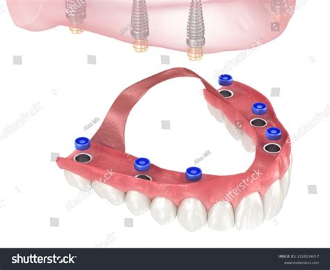 Removable Prosthesis Based On Six Implants Stock Illustration 2224159217 Shutterstock