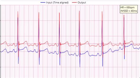 Dr Sanjeev Sarpal On Linkedin Algorithms Arm Ecg Biomedical Fda Telemedicine 15 Comments
