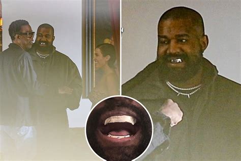 Kanye West Sparks Concern With Swollen Face As He Shows Off 850k