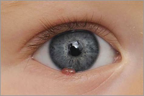 Lower Eyelid Lesion Dermatology Jama Ophthalmology Jama Network