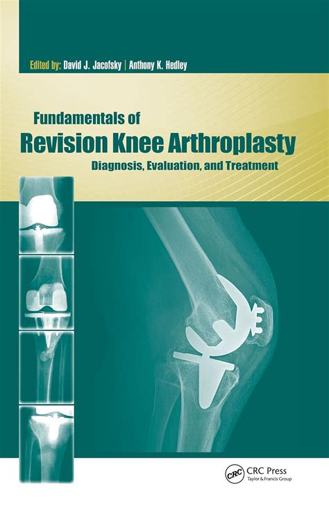 Fundamentals Of Revision Knee Arthroplasty Diagnosis
