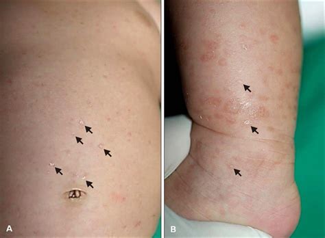 Anetoderma Developing In Generalized Granuloma Annulare In An Infant