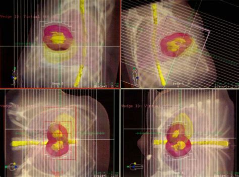 Multileaf Collimator Treatment Fields Download Scientific Diagram