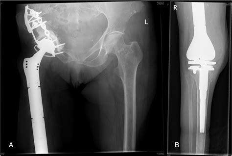 Pelvic Reconstruction With A Free Vascularized Distal Femur For Revision Total Hip Arthroplasty