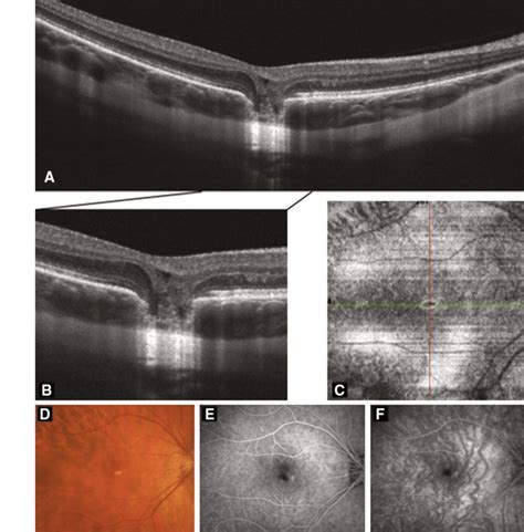 Patient 3 A Oct B Scan With Enlarged Image In B The Scan Revealed